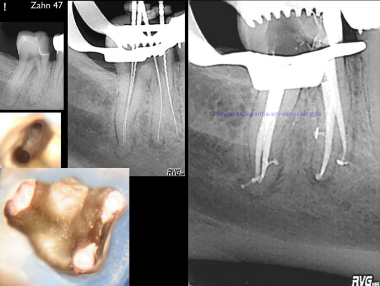 Behandlungsbeispiele - Endodontie Venusberg